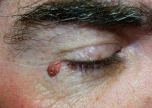 Soins pour homme | Excroissance de la peau et réparation du lobe d'oreille